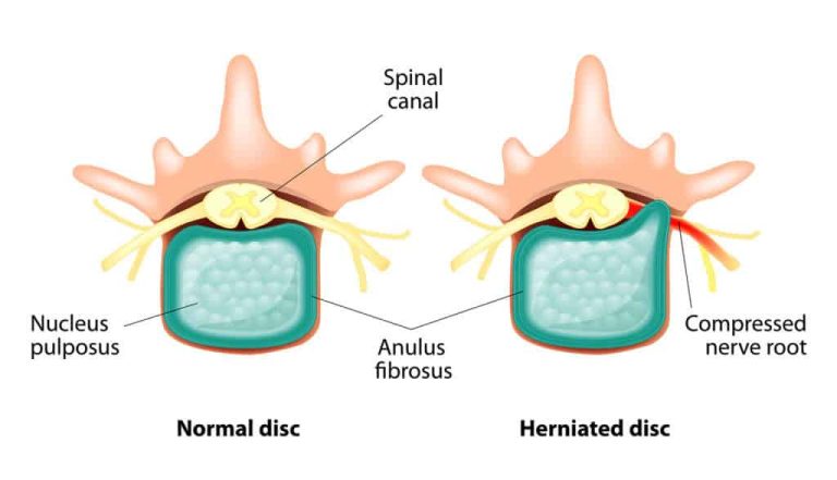 Warning Signs of French Bulldog Slipped Disc Disease (IVDD) | Dog ...